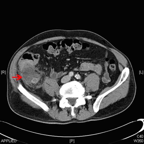 Computed Tomography Scan Showing Appendix Mucocele Download