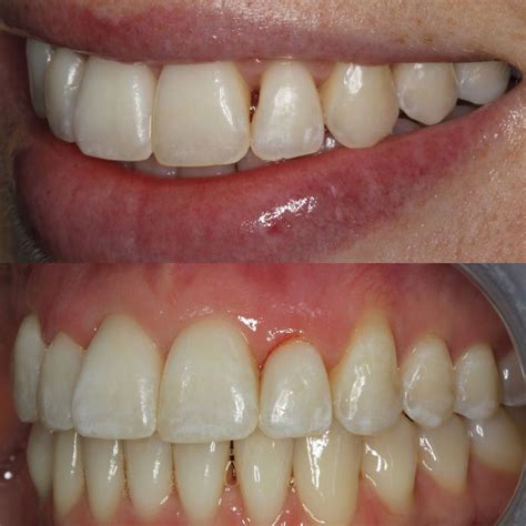 Black Triangles Boulton Dental