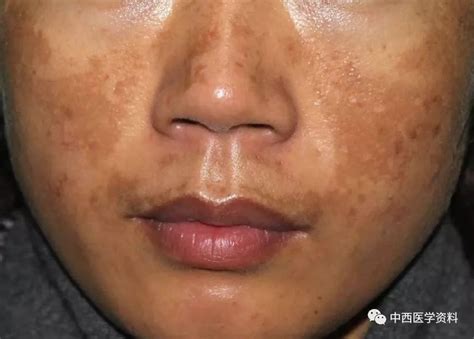 脸上长斑图片分析图解各种斑的区别图解 伤感说说吧