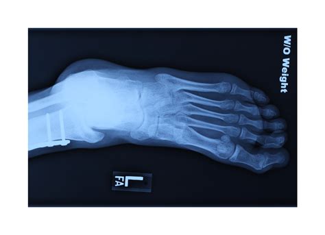 Tarsal Tunnel Release Surgical Education Learn Surgery Washington