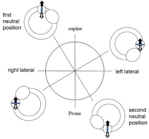 Newly Classified Horizontal Canal Positional Nystagmus And Its Treatment