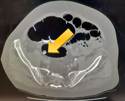 Figure From A Balance Of Clinical Assessment And Use Of Diagnostic Imaging A CT Colonography