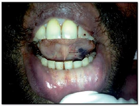 Figure 1 From A Death Due To Ecstasy A Case Report Semantic Scholar