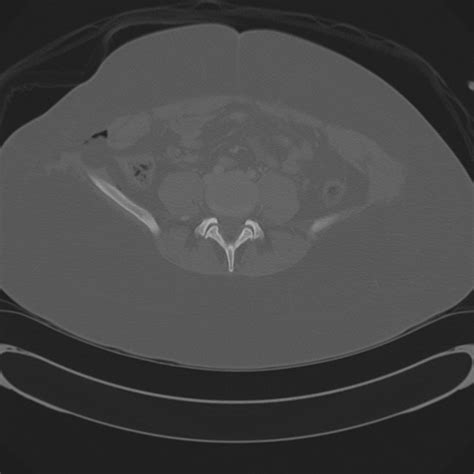 Blood In Uterovesical And Rectovesical Pouch In Trauma Patient