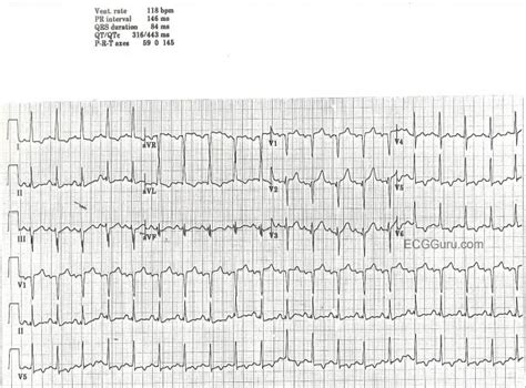 Ischemia Ecg Guru Instructor Resources