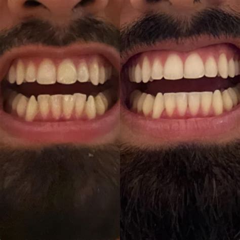 ~7 Months Fast Braces R Braces