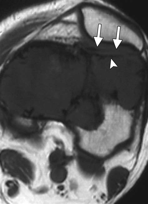 Imaging Characteristics Of Primary Osteosarcoma Nonconventional