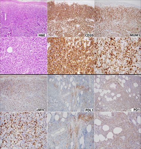 Histopathological Evaluation Reveals A Dense Diffuse Lymphoid