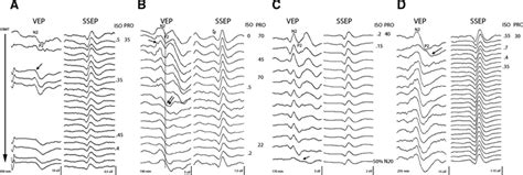 Vep And Ssep Monitoring In Four Patients Time Proceeds From Top Download Scientific Diagram