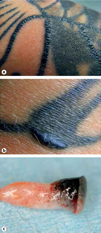 Papulo Nodular Pattern A Elevated Black Lines With Irregular And Download Scientific Diagram