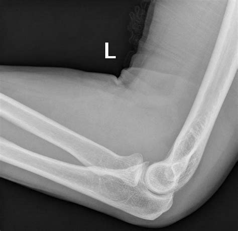 Proximal Radial Head Fracture Splint Frosdsplash