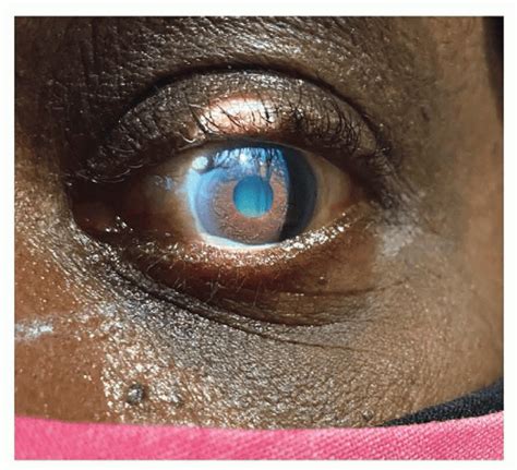 Angle Closure Glaucoma Anesthesia Key