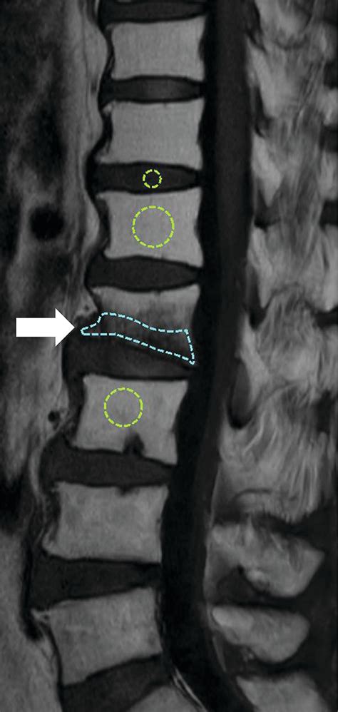 Compression Fracture Mri With Or Without Contrast At Arthur Poulsen Blog