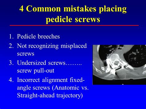Instructional Powerpoint On The Free Hand Technique Of Thoracic Pedicle