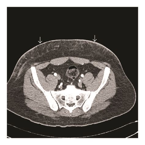 A Ct Abdomen Coronal View Showing Inflamed Appendix Red Arrow A Ct Abdomen Coronal View Showing Inflamed Appendix Red Arrow