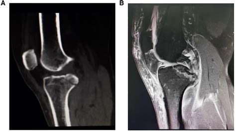 Preoperative Radiograph Of Posterior Cruciate Ligament Pcl Avulsion