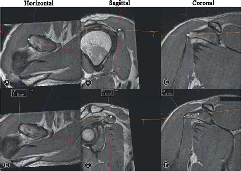 Data Acquisition From 3d Mri Pd‐space‐cor Imaging The Coracoid Tip Is Download Scientific