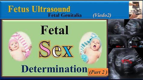 Fetus Ultrasound Fetal Sex Determination Part2 Youtube