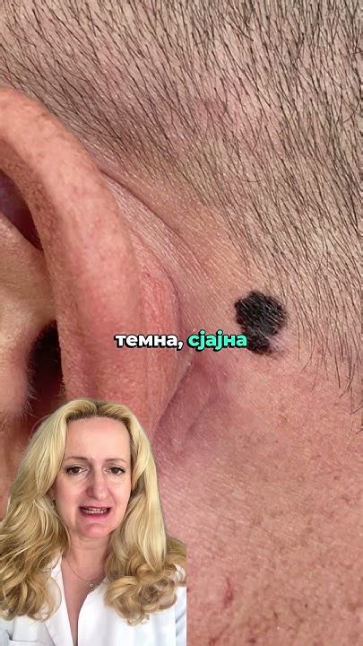 Кај мажите често место за појава на меланом и други видови на рак на кожа е регијата зад ушите