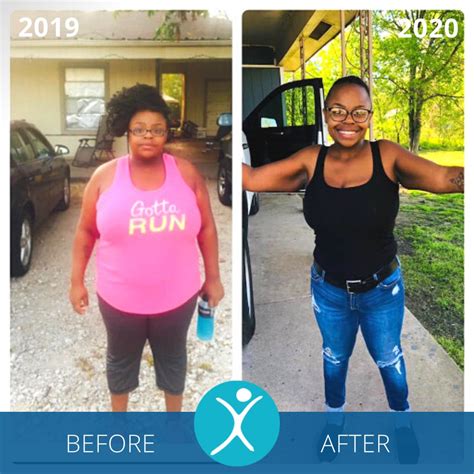 Gastric Sleeve Before And After 2022