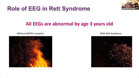 Retted Epilepsy Treatments In Rett Syndrome Feat Robin Ryther Md
