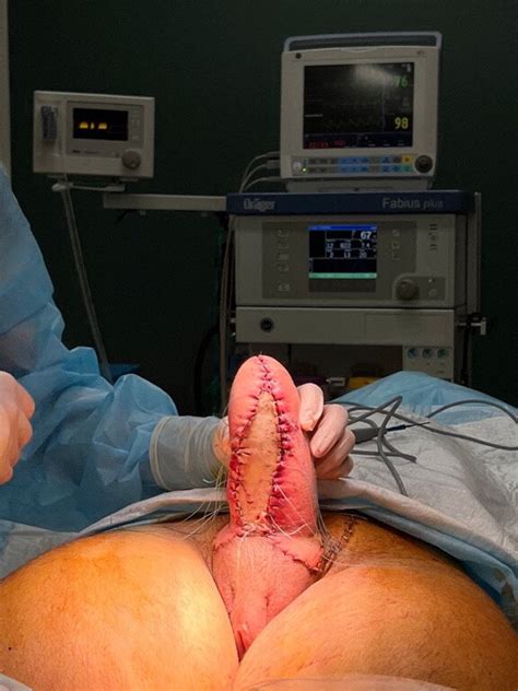 Applying Of The Split Thickness Graft Download Scientific Diagram