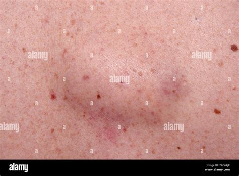 Sebaceous Cyst Close Up Of A Sebaceous Cyst On A 39 Year Old Male Patients Back A Sebaceous