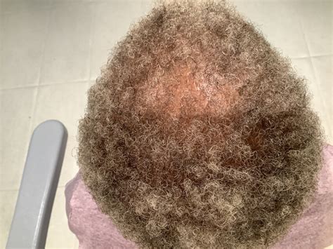 Patient With Noted Thinning And Diffuse Erythema At The Mid Frontal To