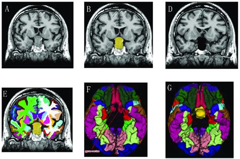 Sub 6 Pituitary Adenoma These Screenshots Present The Segmentation Download Scientific