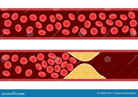 Cholesterol And Atherosclerosis Stock Vector Illustration Of