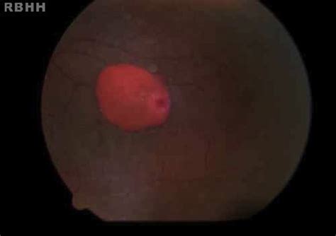 Sickle Cell Retinopathy Salmon Patch