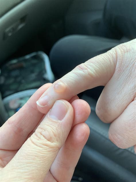 Digital Mucous Cyst On My Moms Pinky Maybe This Isnt Allowed Because It Actually Shouldnt Be