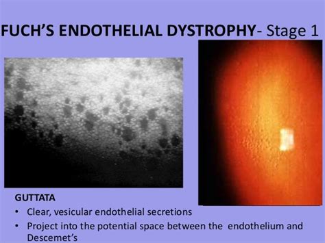 Corneal Dystrophies