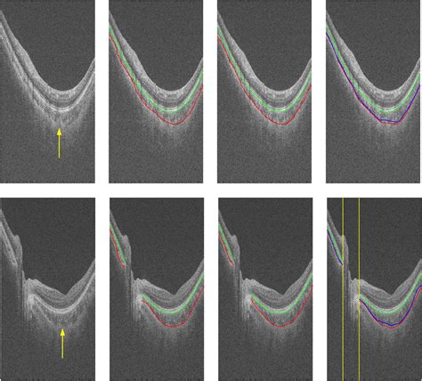 automated choroid segmentation in three dimensional 1 μm wide view oct