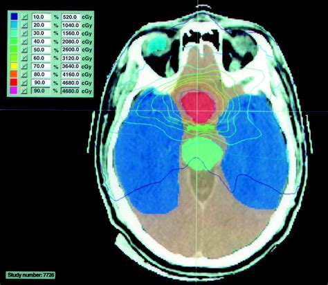 Intensity Modulated Radiation Therapy Imrt In Iran Medpersia