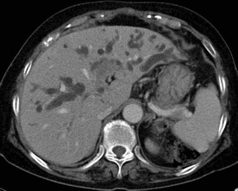 Liver Atlas Case 21 Cholangiocarcinoma