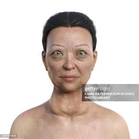 Hyperthyroidism Eye Photos And Premium High Res Pictures Getty Images