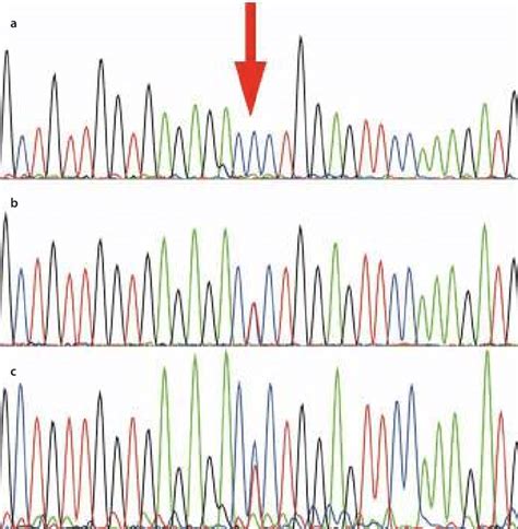 Electropherogram Of The Patient Showing The Nucleotide Variant At
