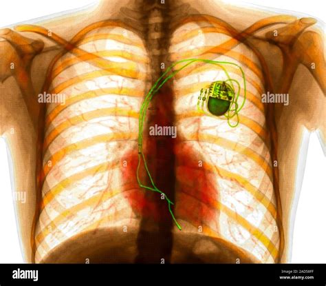 Cardiac Pacemaker Coloured Chest X Ray Showing An Implanted Cardiac Pacemaker Green Upper