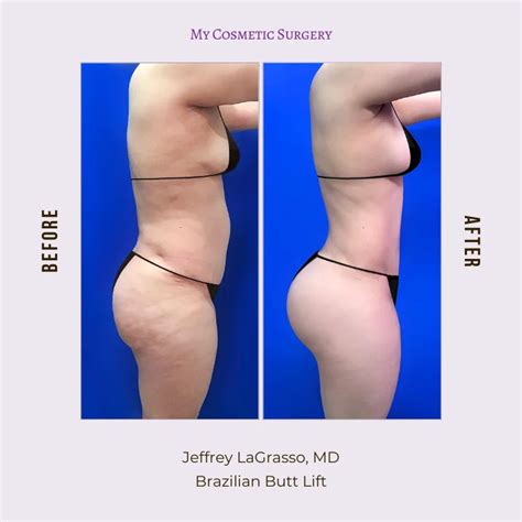 Jeffrey Lagrasso Md Brazilian Butt Lift My Cosmetic Surgery