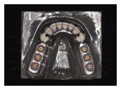 Model Of Mandibular Kennedy Class I Bilateral Distal Extension Missing
