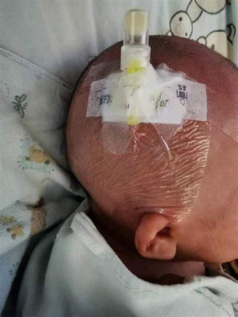 Scalp Indwelling Needle Puncture And Fixation In The Right Superficial