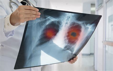 Understanding Lung Cancer Causes Symptoms And Treatment 365 Cancer Prevention Society