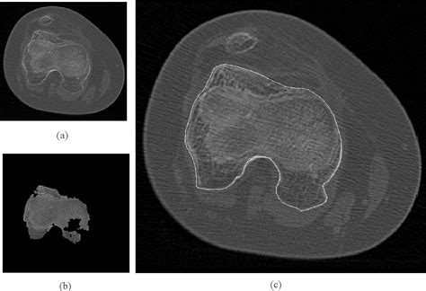 Figure From A Combined Approach To D Medical Image Segmentation Using Marker Based Watersheds