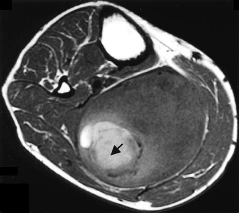 Imaging Of Ancient Schwannoma Ajr