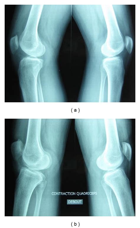Treatment Of Habitual Patellar Dislocation In An Adult By Isolated