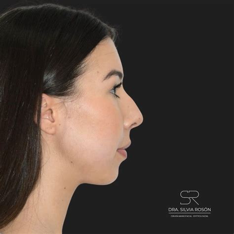 Retrognatia Mandibular Cirugía Ortognática Clase Ii Dra Rosón