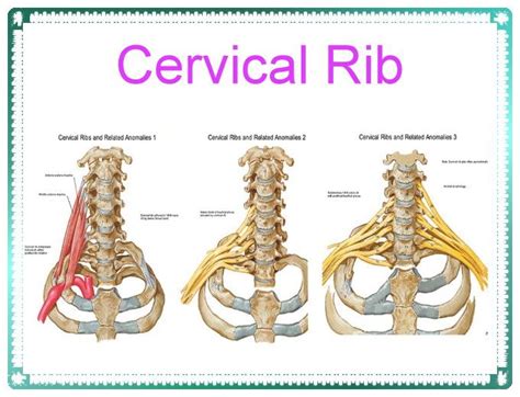 Cervical Rib Cervical Rib Health
