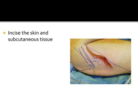 Free Ld Flap For Scalp Reconstruction Dr Vipin V Nair Pptx Death Injury Or Military