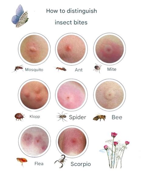 Insect Bites Identification Chart Insect Bite Pictures Bugs Bites